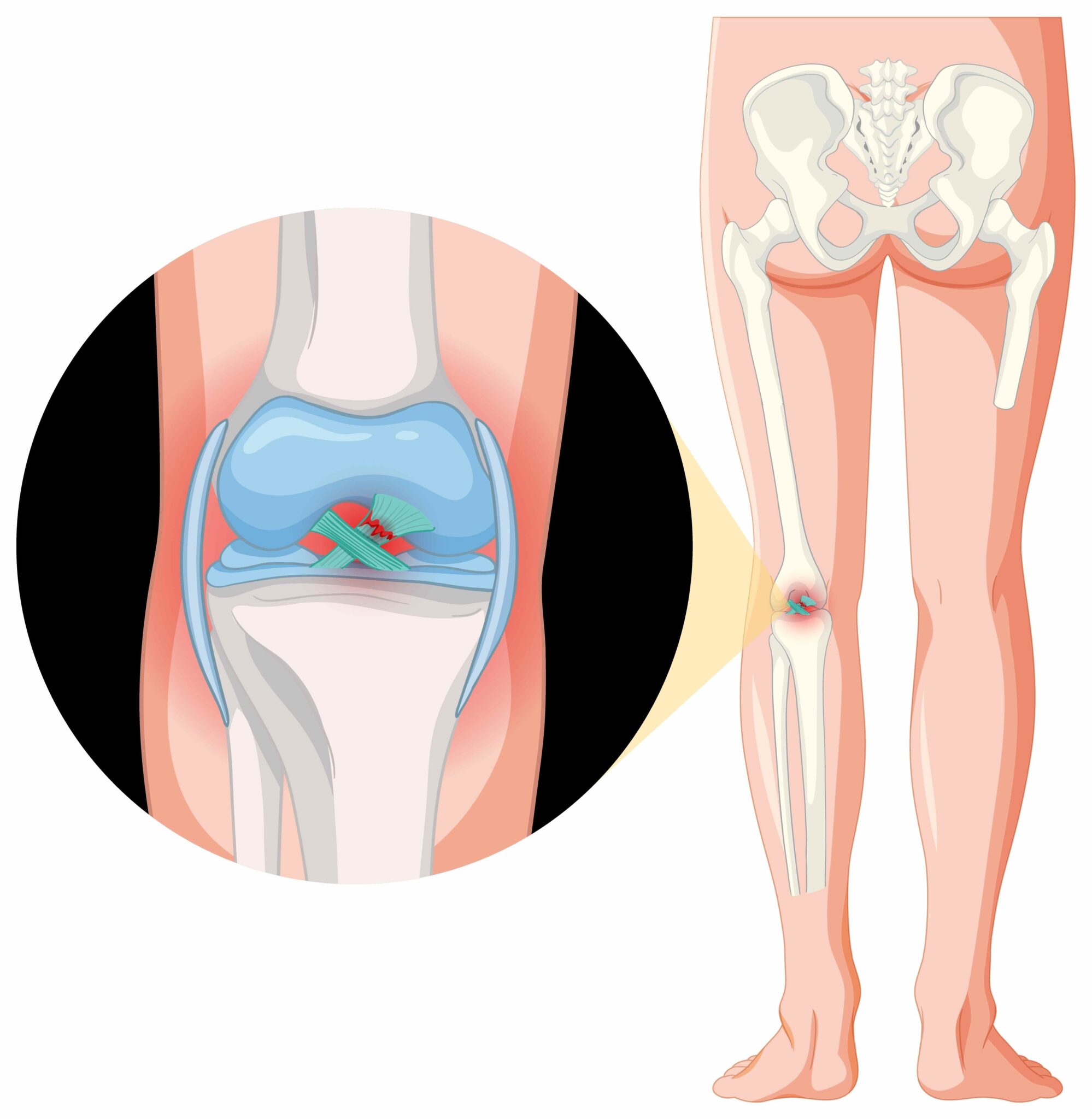 O que é Ligamento Cruzado Anterior (LCA)? - Science Valley